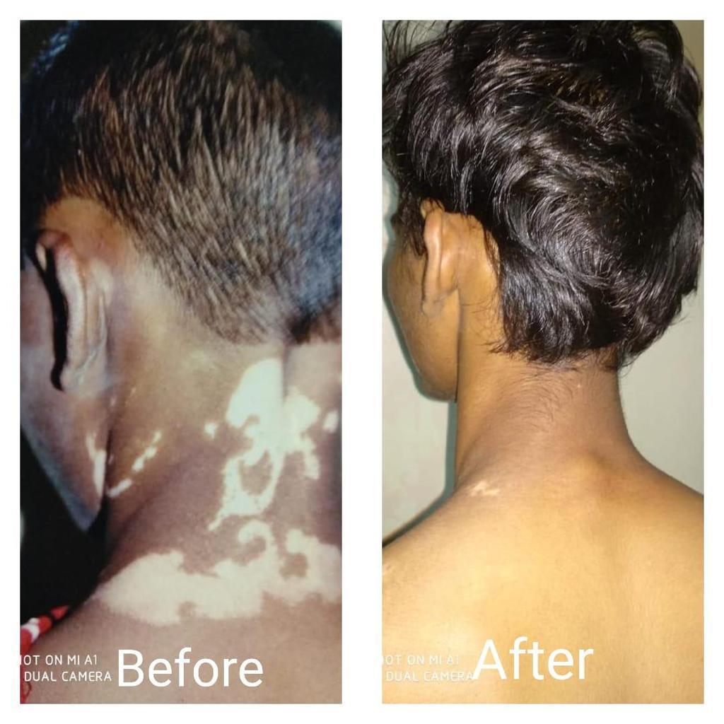 Permanent Vitiligo Cure with Homeopathy | Ask Dr. Kabra