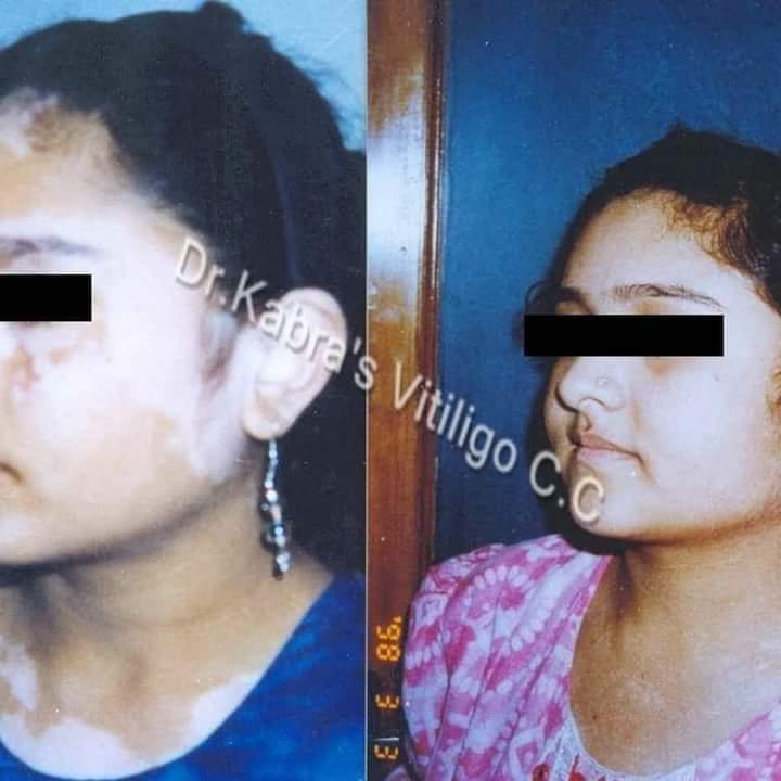 Permanent Vitiligo Cure with Homeopathy | Ask Dr. Kabra